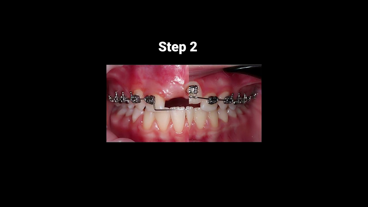 How Braces ACTUALLY Work