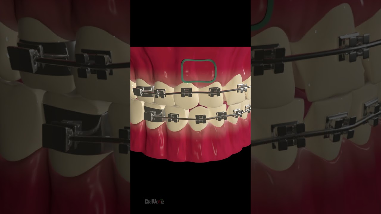 How Braces ACTUALLY Work