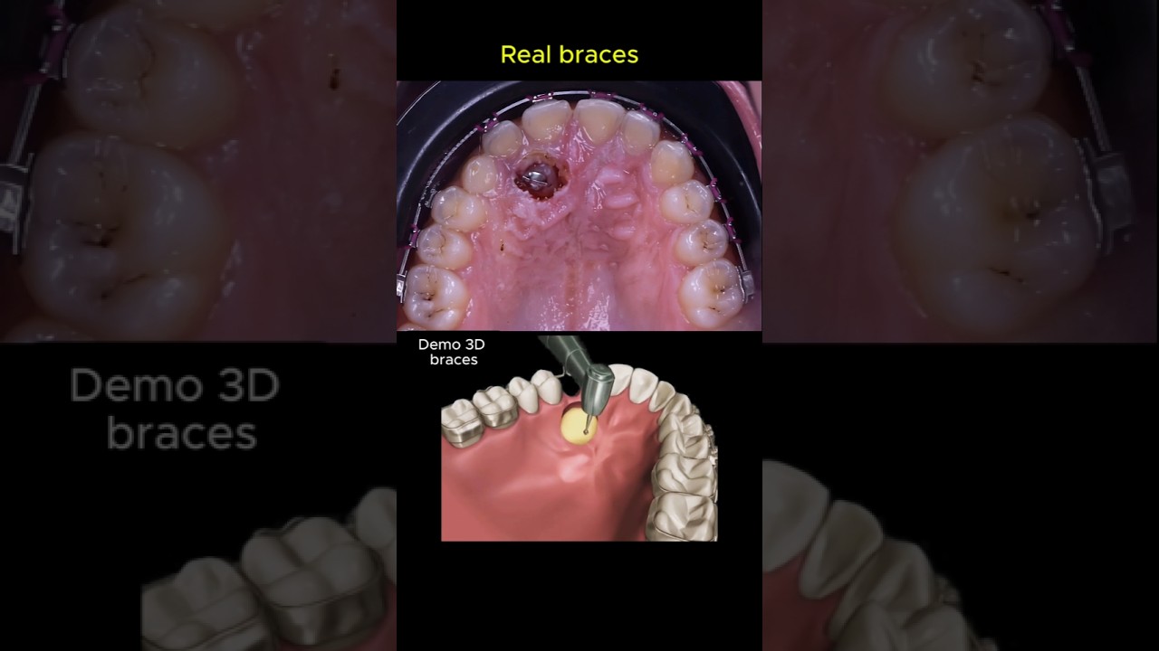 عجيب جدا | ناب منطمر impacted tooth